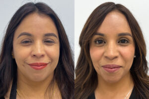 Why Is Your Botox Wearing Off After 1 Month?